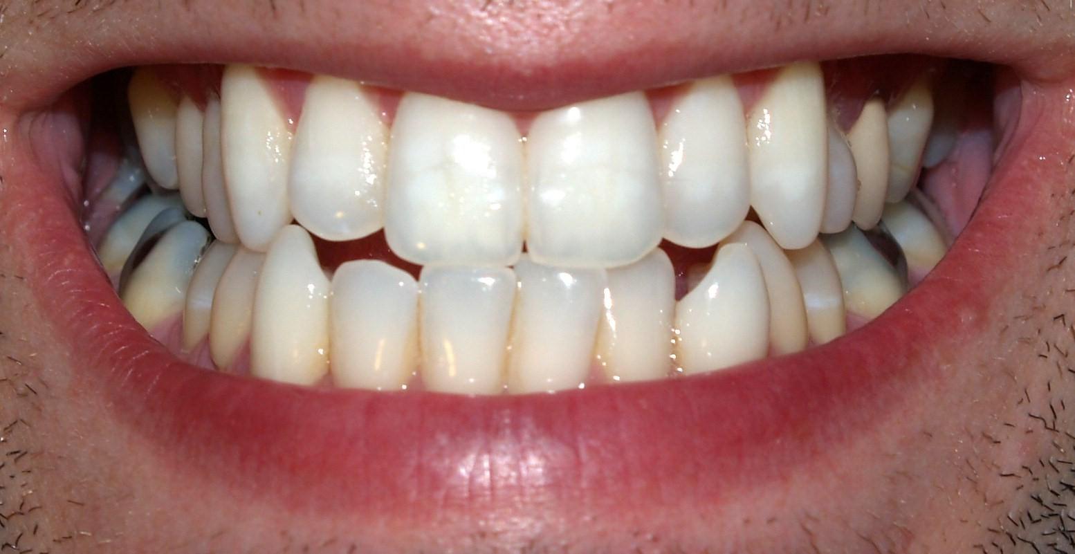Green Report: Study suggests long-term smokers could suffer from gum ...